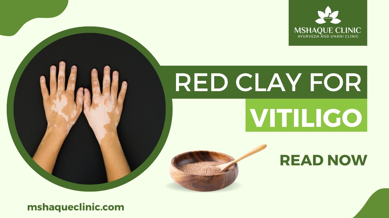Red Clay For Vitiligo- All You Need To Know - MSHaque Clinic